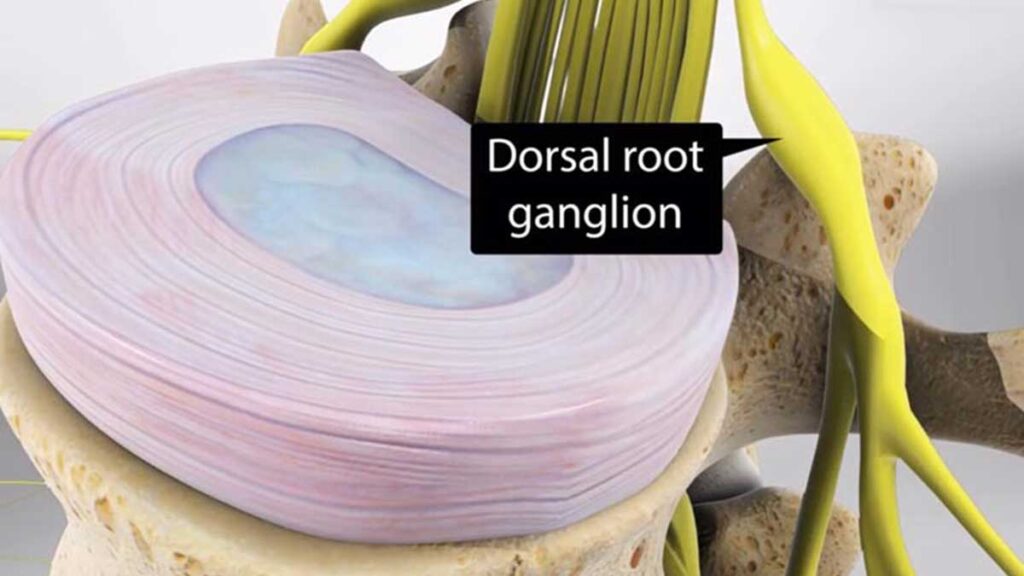 Dorsal Root Ganglion Symptoms – Ganglion Racine Dorsale – IRMT